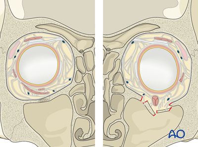 Periorbital dissection - Introduction