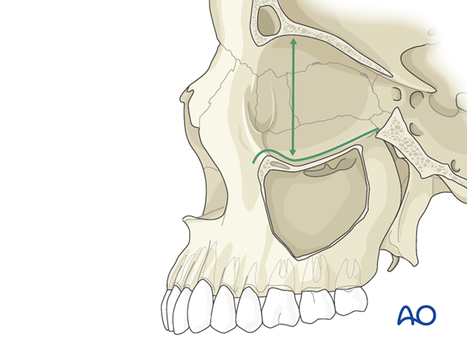 Bony anatomy of the orbit