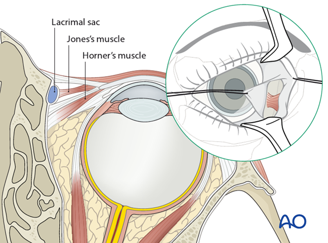 Periorbital dissection - Introduction