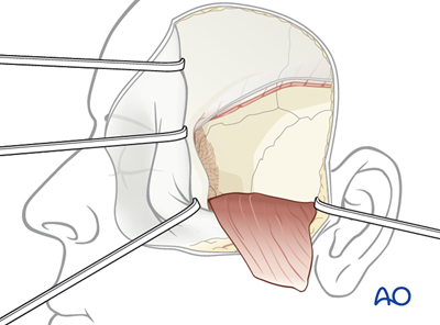 Adjunctive access procedures (orbitotomies)