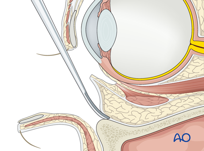 Periorbital Dissection of Inferior orbital wall/Orbital floor