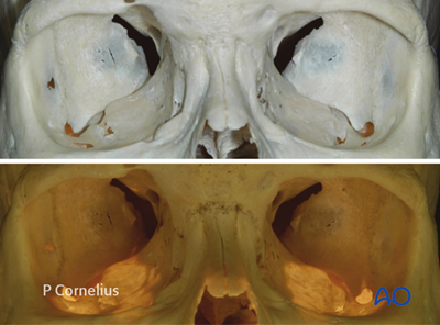 Bony anatomy of the orbit