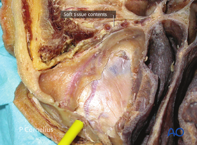 Periorbital Dissection of Inferior orbital wall/Orbital floor