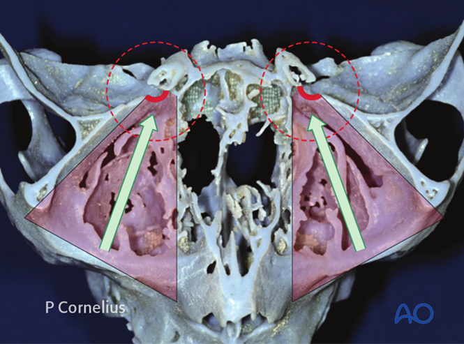 Periorbital Dissection of Inferior orbital wall/Orbital floor