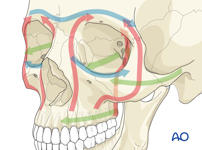 Panfacial fractures (sequencing of repair)