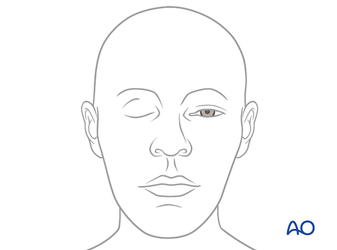 Examination of patients with midfacial post traumatic deformities