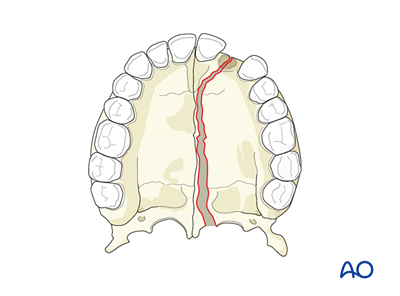 Palatoalveolar fracture, simple