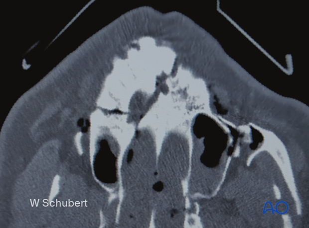 Palatoalveolar fracture, comminuted