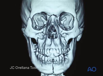 Le Fort II fracture