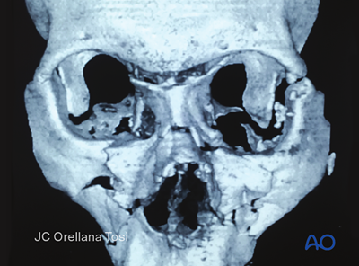 Le Fort II fracture