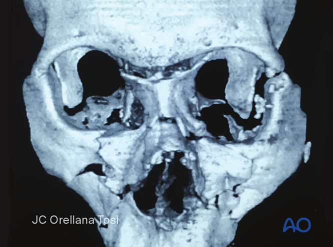 Le Fort II fracture