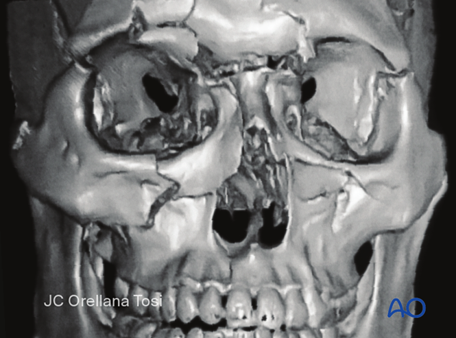 Le Fort III fracture