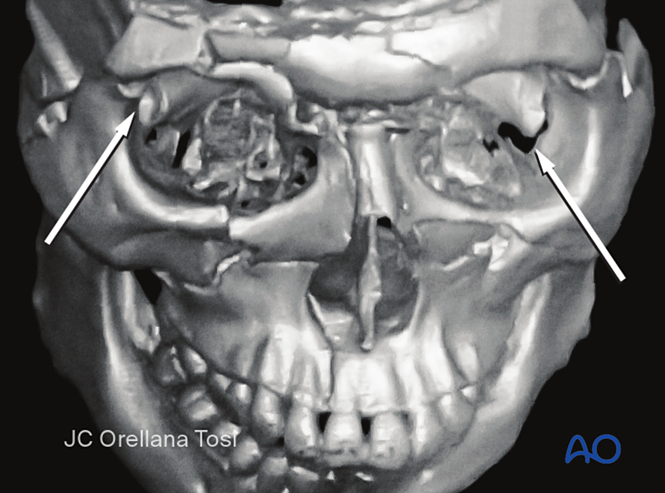 Le Fort III fracture