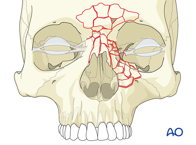 NOE Type III fracture