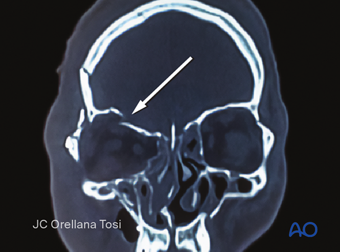 Orbital roof fracture