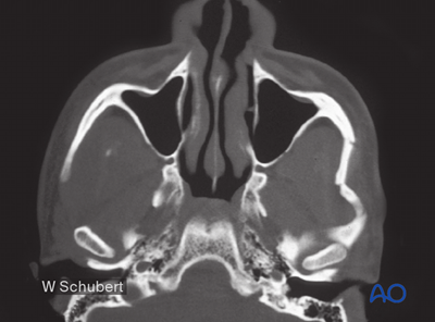 Zygoma, isolated zygomatic arch fracture