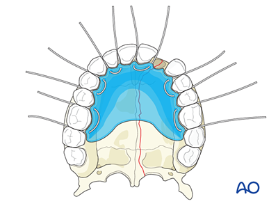 Open reduction internal fixation for Palatoalveolar fracture, simple