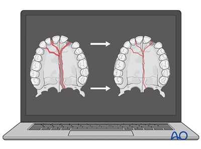 Closed treatment for Palatoalveolar fracture, comminuted