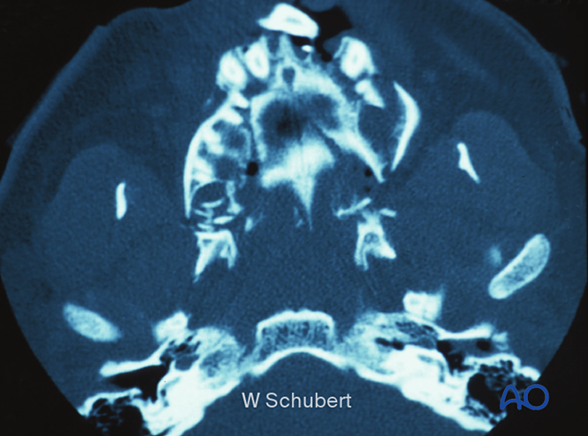 Palatoalveolar fracture, comminuted