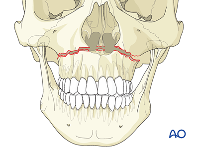 Open reduction internal fixation for Le Fort I fracture, simple