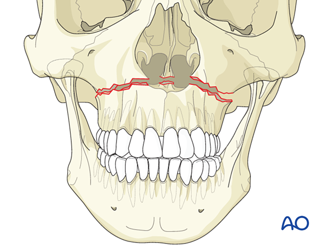 Le Fort I fracture, simple