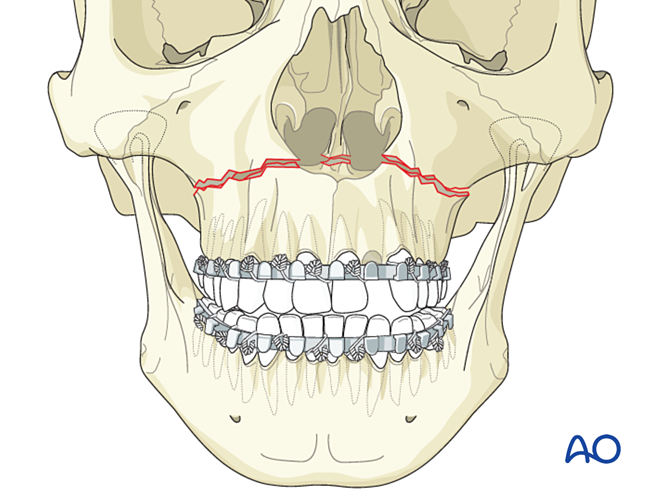 Open reduction internal fixation for Le Fort I fracture, simple
