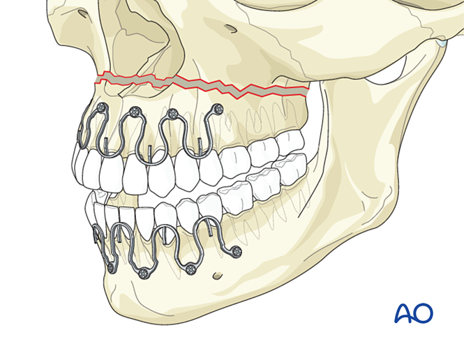 Open reduction internal fixation for Le Fort I fracture, simple