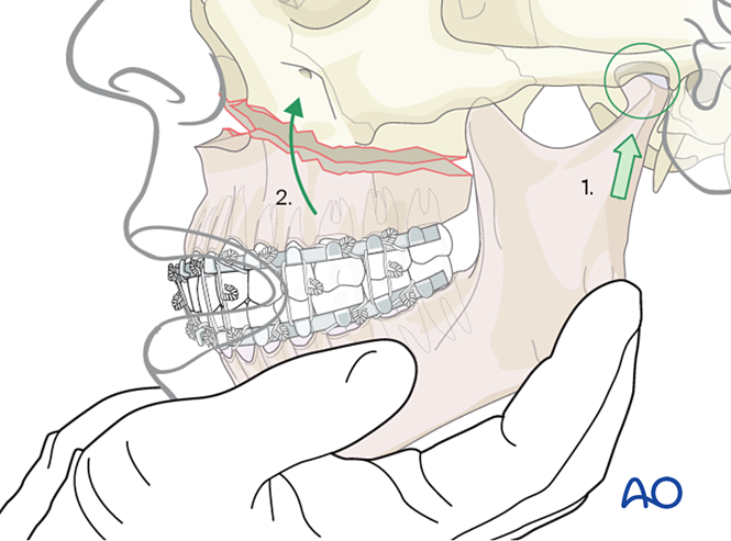 Open reduction internal fixation for Le Fort I fracture, simple