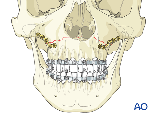 Open reduction internal fixation for Le Fort I fracture, simple