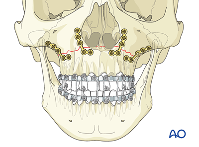 Open reduction internal fixation for Le Fort I fracture, simple