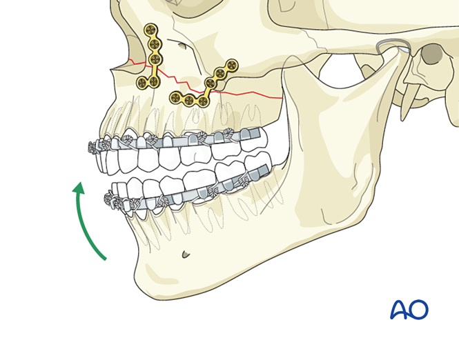 Open reduction internal fixation for Le Fort I fracture, unilateral ...