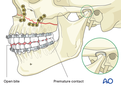 Open reduction internal fixation for Le Fort I fracture, unilateral ...