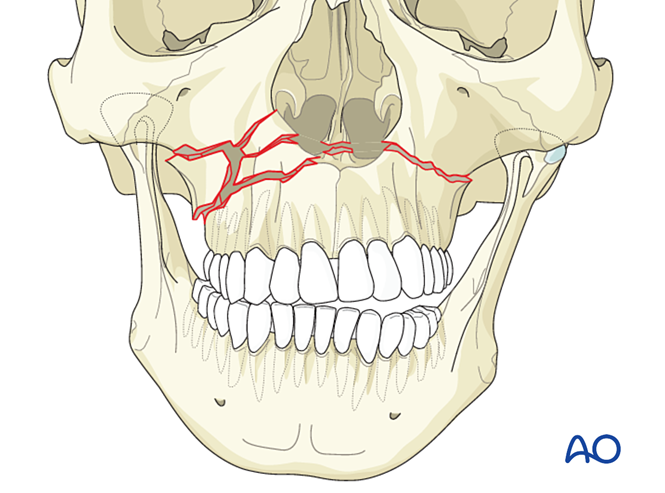Open reduction internal fixation for Le Fort I fracture, unilateral ...