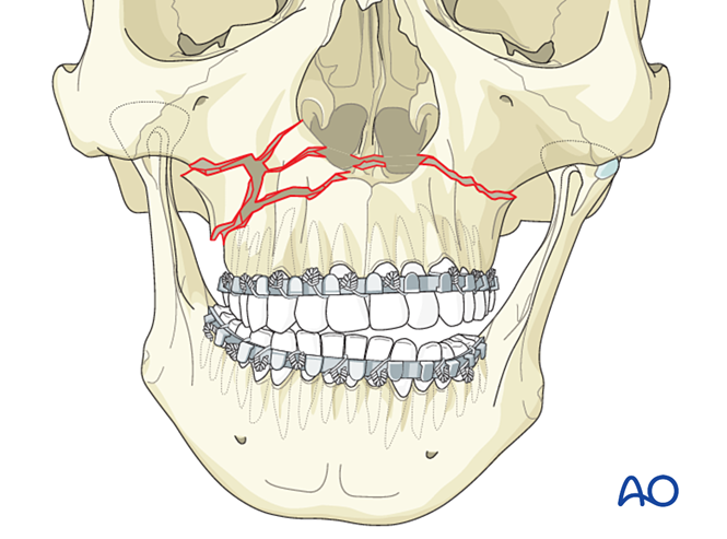 Open reduction internal fixation for Le Fort I fracture, unilateral ...