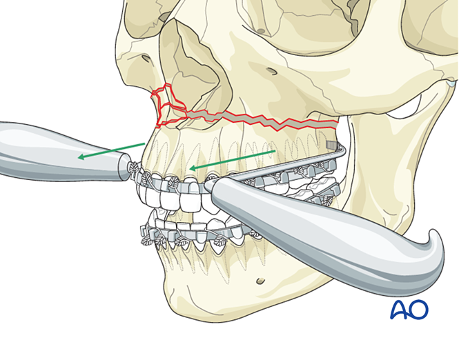 Open reduction internal fixation for Le Fort I fracture, unilateral ...