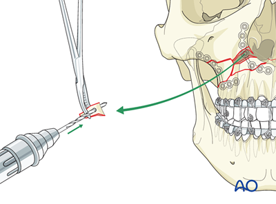 Open reduction internal fixation for Le Fort I fracture, unilateral ...