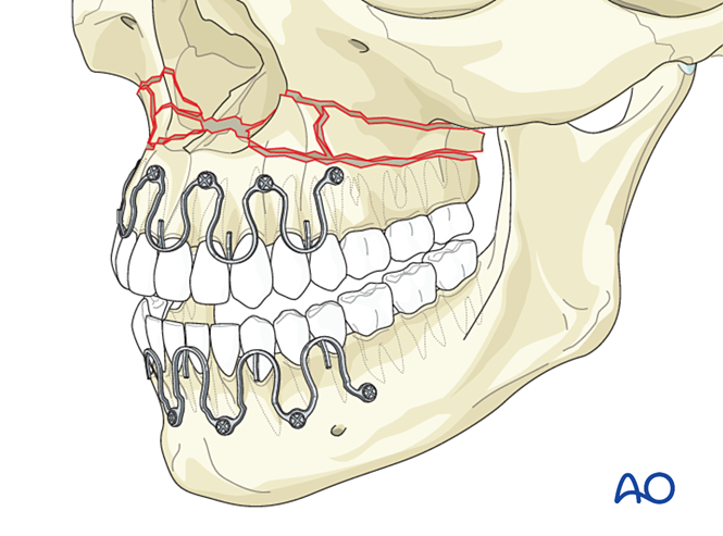 Open reduction internal fixation for Le Fort I fracture, bilateral ...