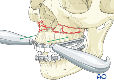 Open reduction internal fixation for Le Fort I fracture, bilateral ...