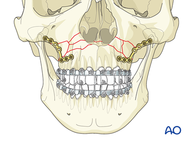 Open reduction internal fixation for Le Fort I fracture, bilateral ...