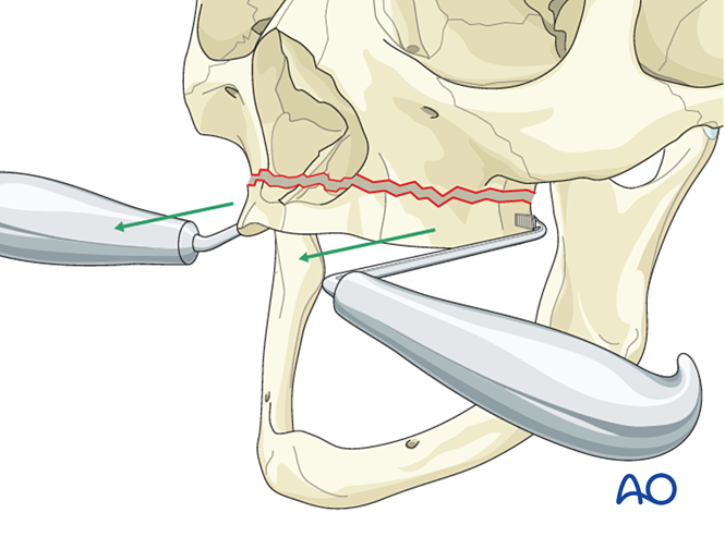 Open reduction internal fixation for Le Fort I fracture, edentulous ...