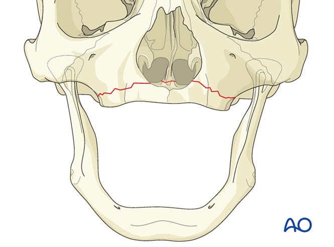 Open reduction internal fixation for Le Fort I fracture, edentulous ...