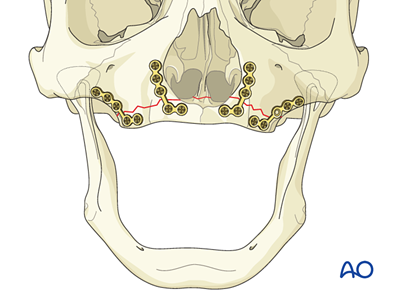 Open reduction internal fixation for Le Fort I fracture, edentulous ...