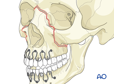 Open reduction internal fixation for Le Fort II fracture