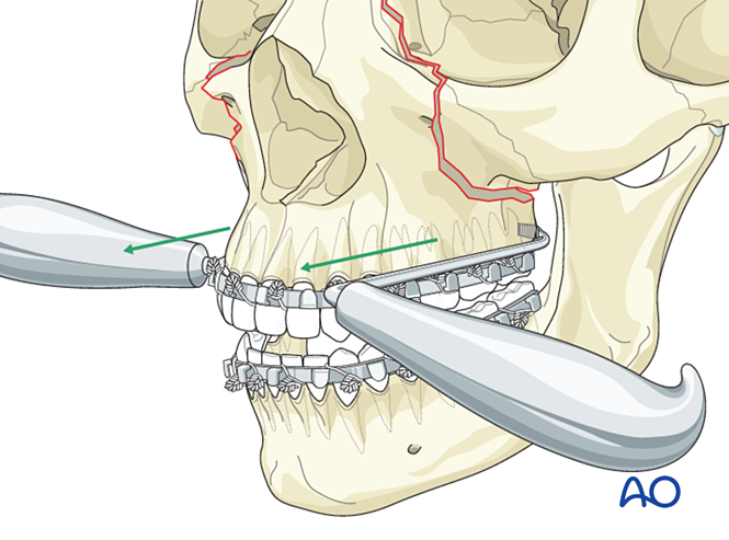 Open reduction internal fixation for Le Fort II fracture