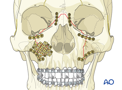 Open reduction internal fixation for Le Fort II fracture