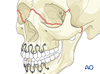 Open reduction internal fixation for Le Fort III fracture