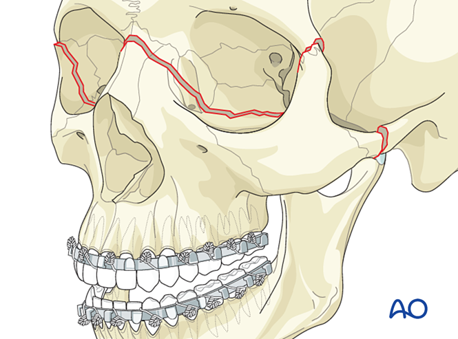 Open reduction internal fixation for Le Fort III fracture