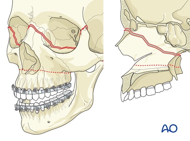 Open reduction internal fixation for Le Fort III fracture