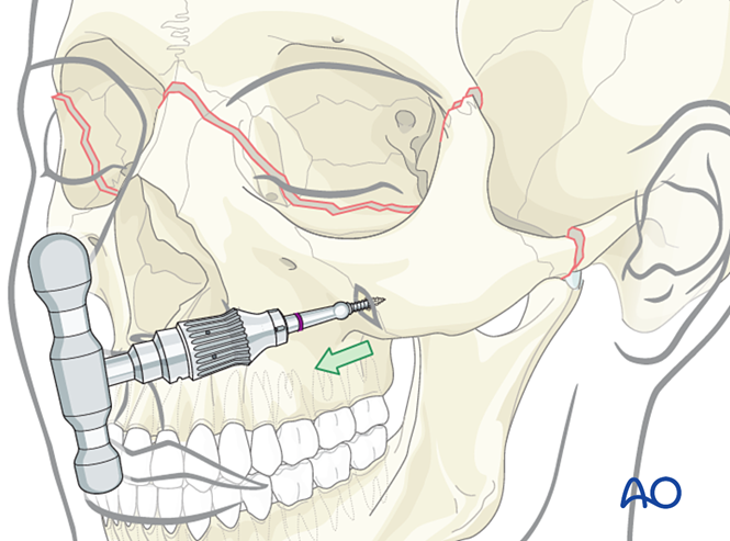 Open reduction internal fixation for Le Fort III fracture