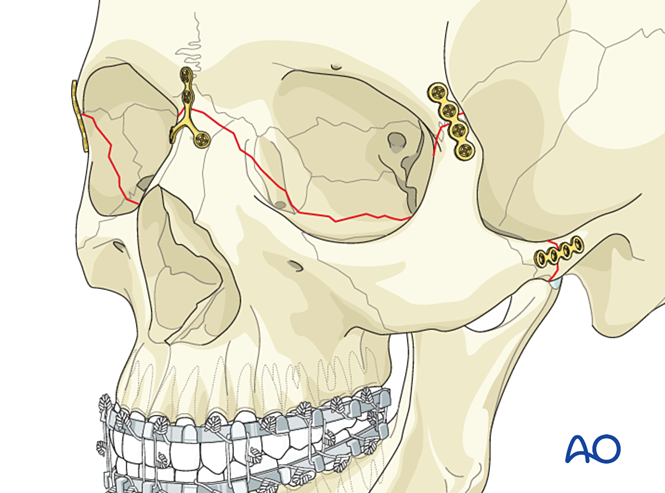 Open reduction internal fixation for Le Fort III fracture